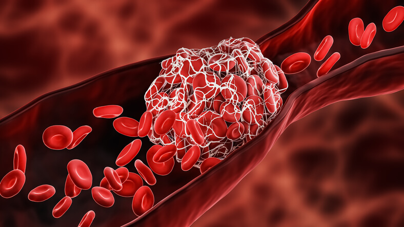 Blood Clots: Types and Causes
